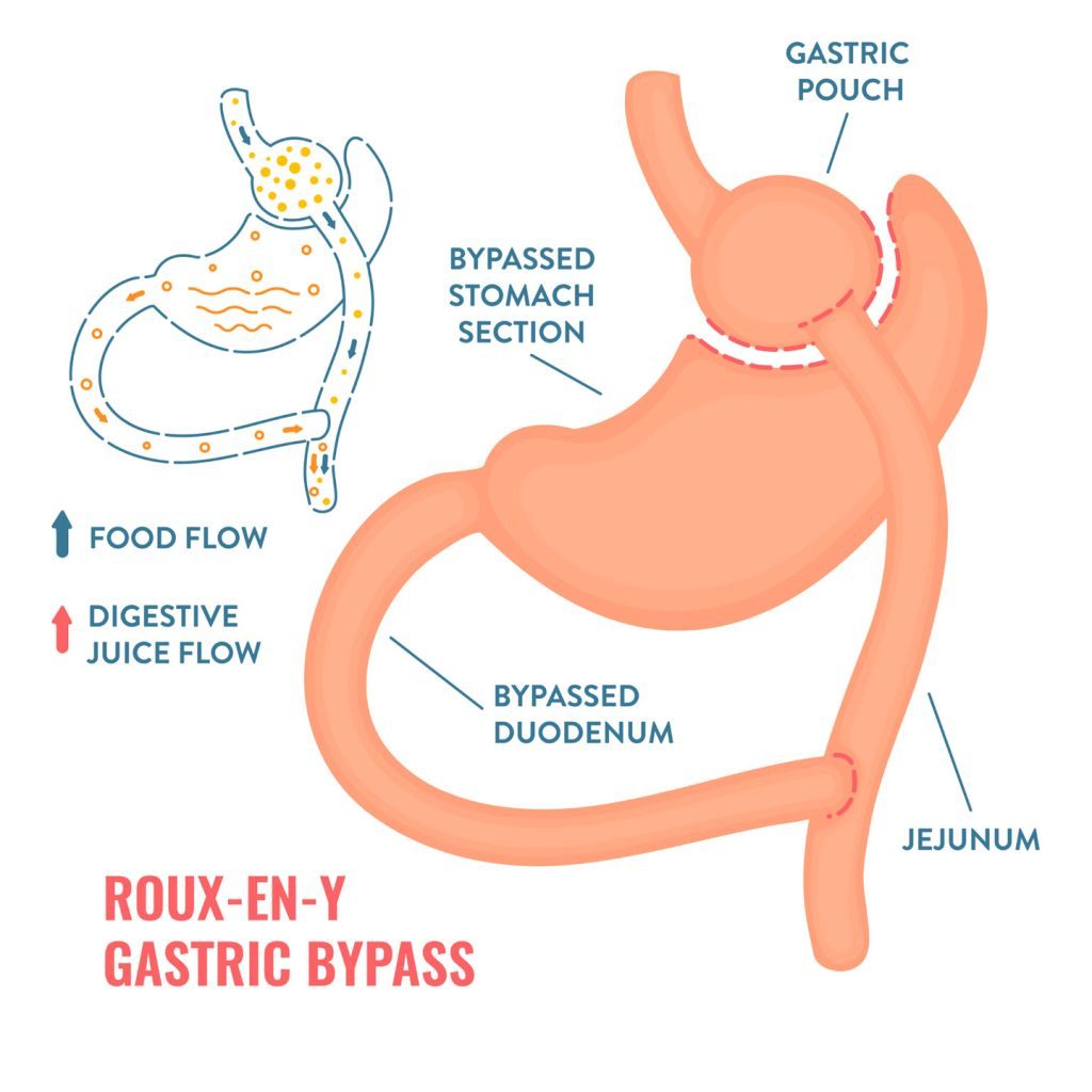 Weight Loss Bariatric Surgical Procedures